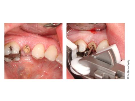 Benex Control Denta Be