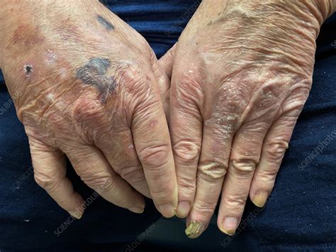 Ringworm Stock Image C057 2374 Science Photo Library