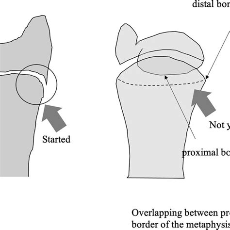 Illustrations To Show “capping Of Distal Radial Physis” And Download Scientific Diagram