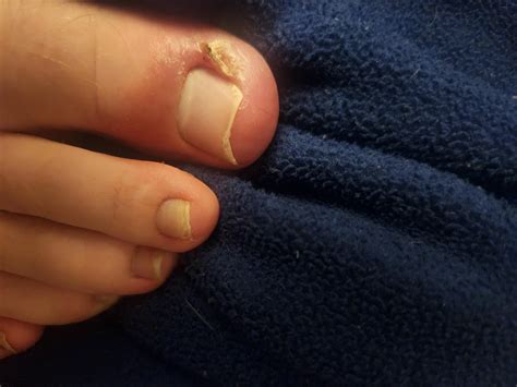 Hypergranulation Tissue Post Surgery R Ingrown Toenails