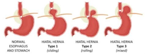 B3192 Gi Abnormalities Flashcards Quizlet