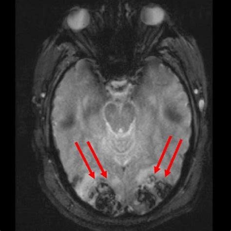 Magnetic Resonance Imaging Of The Head With Gradient Echo Sequence
