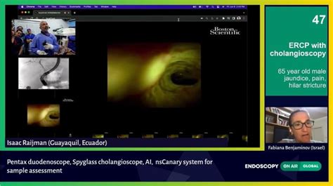 Isaac Raijman On Linkedin Ercp With Cholangioscopy Isaac Raijman Endoscopy On Air