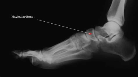 Accessory Navicular Bone Xray At Susan Cummings Blog