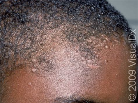 Wart On Scalp