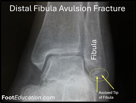 Fibular Avulsion Fracture Footeducation