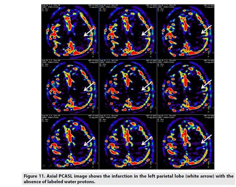 Clinical Approach Of Perfusion Weighted Imaging