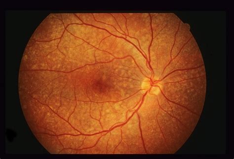 Birdshot Chorioretinopathy