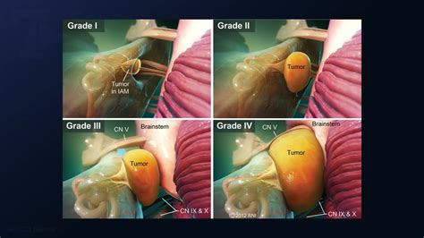Extended Retrosigmoid Craniotomy For Resection Of A Large Cystic Schwannoma Youtube
