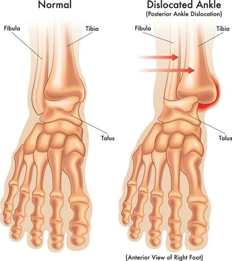 Ankle Dislocation Diagram