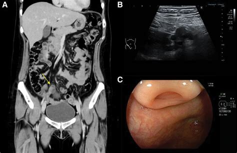 Laparoscopic Resection For Appendiceal Mucocele Secondary To Medicine