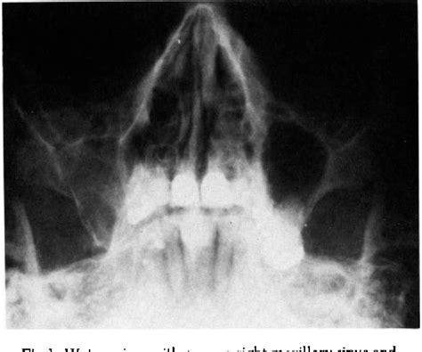 Figure 1 From Maxillary Sinus Mucocele Semantic Scholar