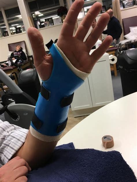 Occupational Therapy Splinting Custom Orthotics Patchogue