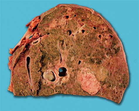 Hepatocellular Carcinoma Gross