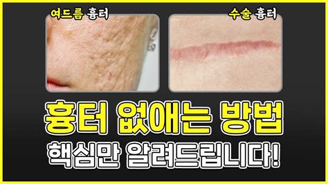 흉터 없애는 법‼ 여드름자국 패인 흉터 수술 후 흉터 100 없앨 수 있나요 Youtube