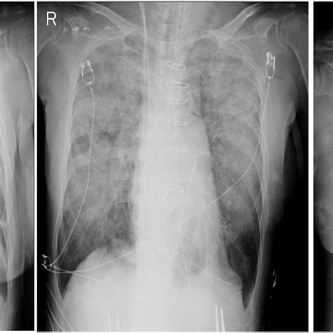 Chest Radiographs Obtained Pre Operation Left Post Operation