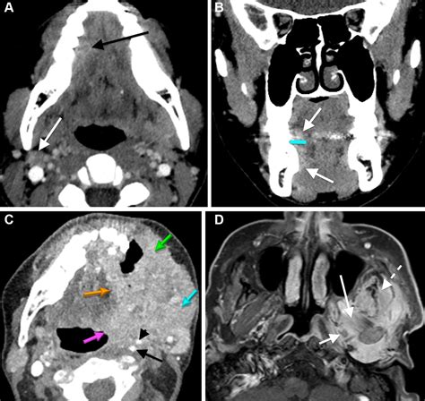 Trends In Head And Neck Cancer Oral Cavity Carcinoma And What The