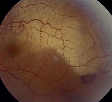 Posterior Segment Pics Flashcards Quizlet