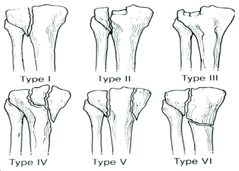 Schatzker Classification 7 Download Scientific Diagram