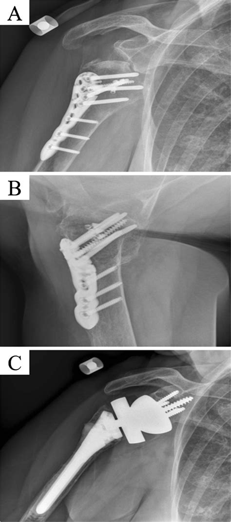 A 71 Year Old Female With Failed ORIF Grashey A And Axillary B Download Scientific Diagram