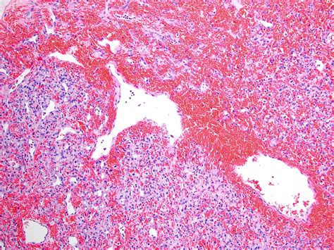 Pathology Outlines Hemangioblastoma