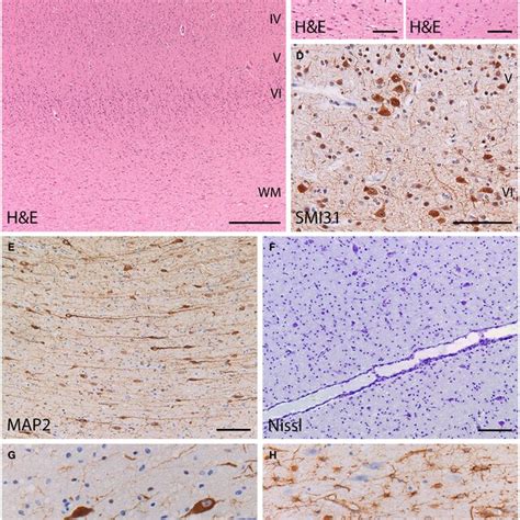 Histopathology Of The Frontal Cortex Shows Mild Malformation Of Download Scientific Diagram