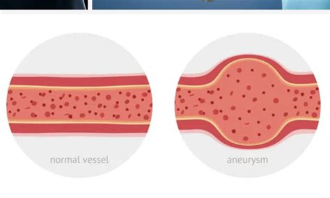 WHAT IS AN ANEURYSM Dr G Opines
