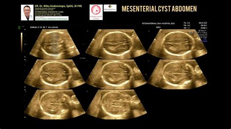 Mesenterial Cyst Abdomen Janin Youtube