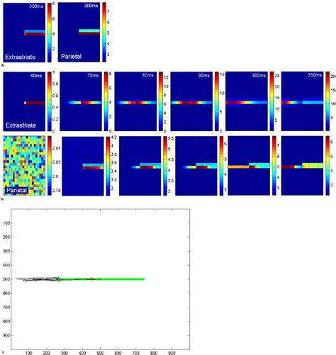 Cortical Activity In Hemianopia With And Without Extrastriate Lateral