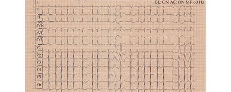 Preprocedural 12 Lead Electrocardiogram Atrial Fibrillation With Rapid Download Scientific