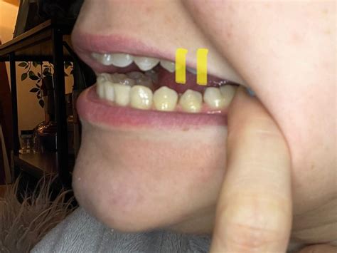 Ipr Gaps Not Closed End Of Refinements Rinvisalign