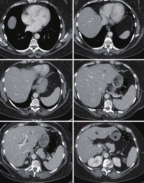 Liver Segmental Anatomy Ct Scan