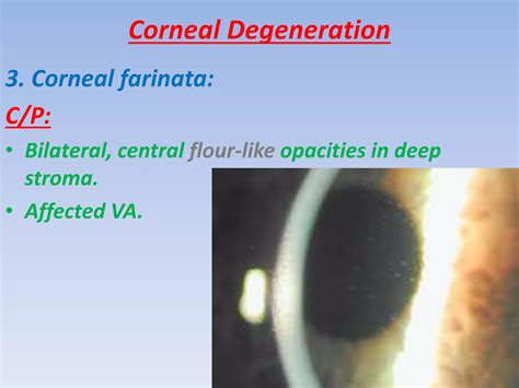 Corneal Degeneration Dystrophies Pptx