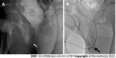 Figure 2 From Interventional Urethral Balloon Dilatation Before Endoscopic Visual Internal