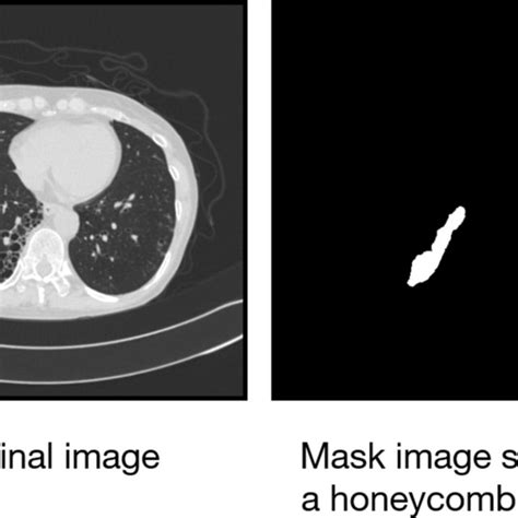Samples Of The Original Ct Image And Mask Image Showing Honeycombing Area Download Scientific