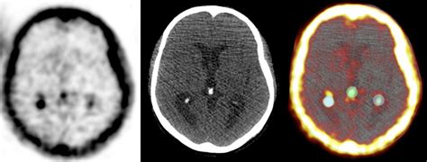Habenular Calcification
