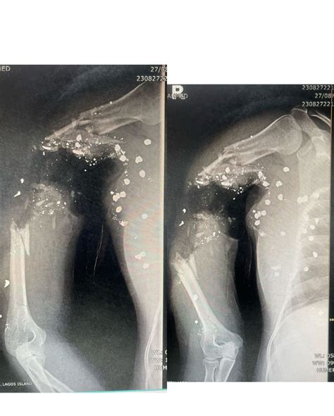 Amanda Eledumo On Linkedin Humerus X Ray Of A Gunshot Victim Showing Total Dissociation Of The…