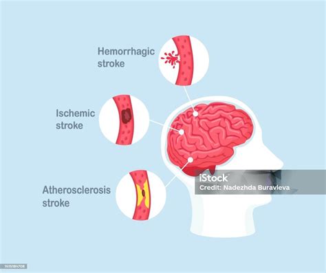 인간의 뇌 뇌졸중의 종류 허혈성 죽상 동맥 경화증 및 출혈성 뇌졸중 질환 뇌졸중에 대한 스톡 벡터 아트 및 기타 이미지 뇌졸중 국소성빈혈 벡터 Istock