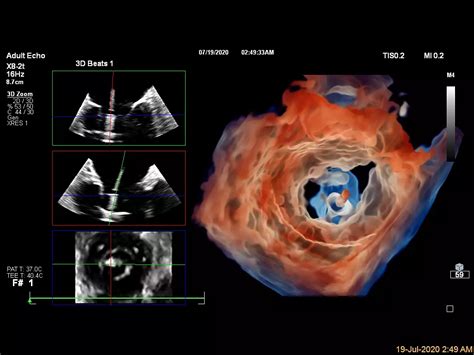 Epiq Cvx Cardiac Ultrasound Philips