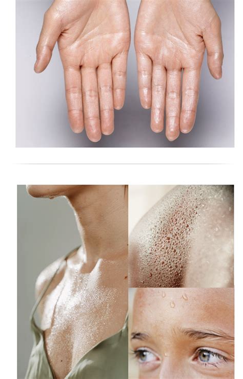 Hyperhidrosis Palm Beach Dermatology Group