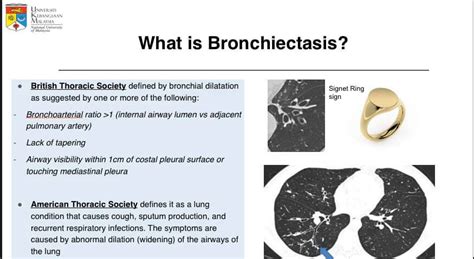 1 What Is Bronchiectasis 2 What Respiratory Ukmmc Facebook