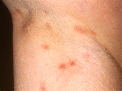 Scabies Rash