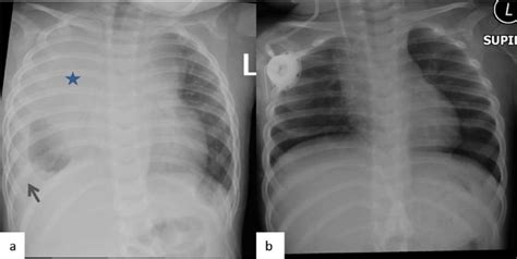 Cxr Pre And Post Induction Frontal Chest X Ray Images A At The Time Download Scientific