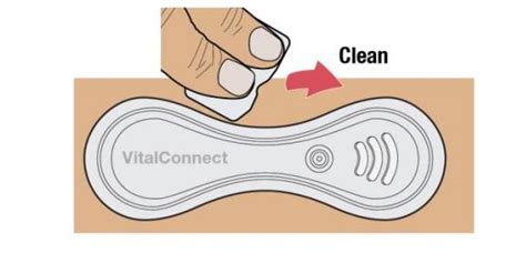 Vitalconnect Vitalpatch Adhesive Overlay Cardiac Monitoring Device