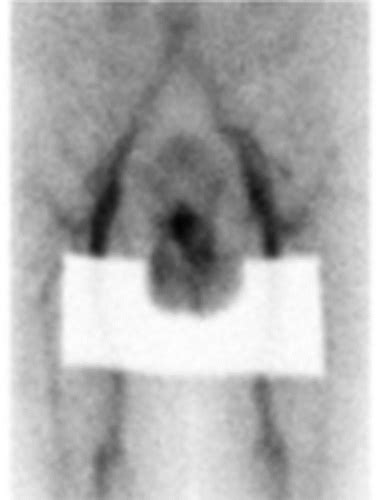 Testicular Scan Flashcards Quizlet