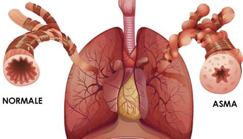 Bronchial Asthma Symptoms And Treatment Emergency Live
