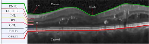 Retinal Oct Image With Nine Layers And Eight Boundaries Nfl Is Nerve
