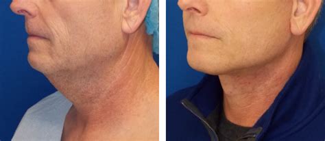 Everything You Need To Know About The Fat Stimulating Injection Renuva Washingtonian Plastic