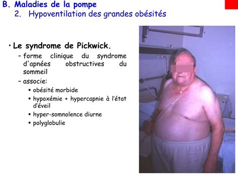 Ppt Insuffisance Respiratoire Chronique Etiologies Et Traitements