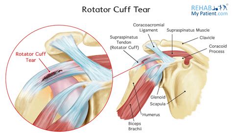 Rotator Cuff Tear Manor View Practice